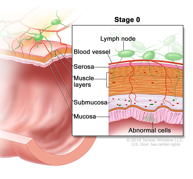 Colon and Rectal Cancer Staging | Compass Oncology