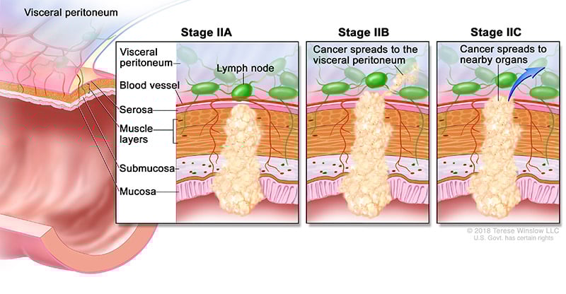 Colon and Rectal Cancer Staging | Compass Oncology