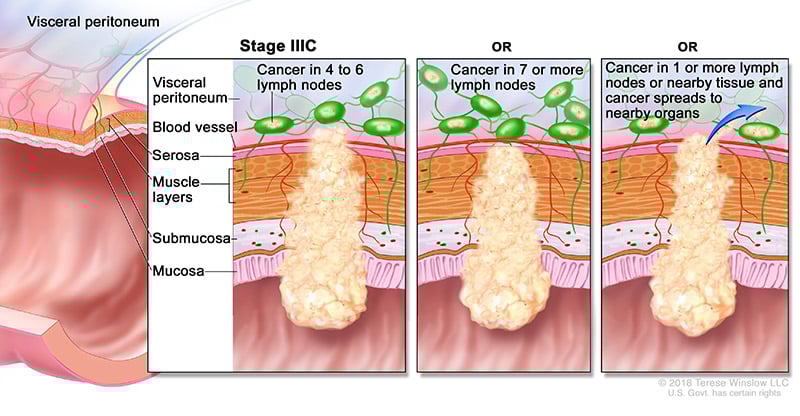 Colon and Rectal Cancer Staging | Compass Oncology