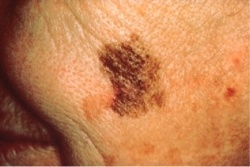 Skin Cancer Detection Guide