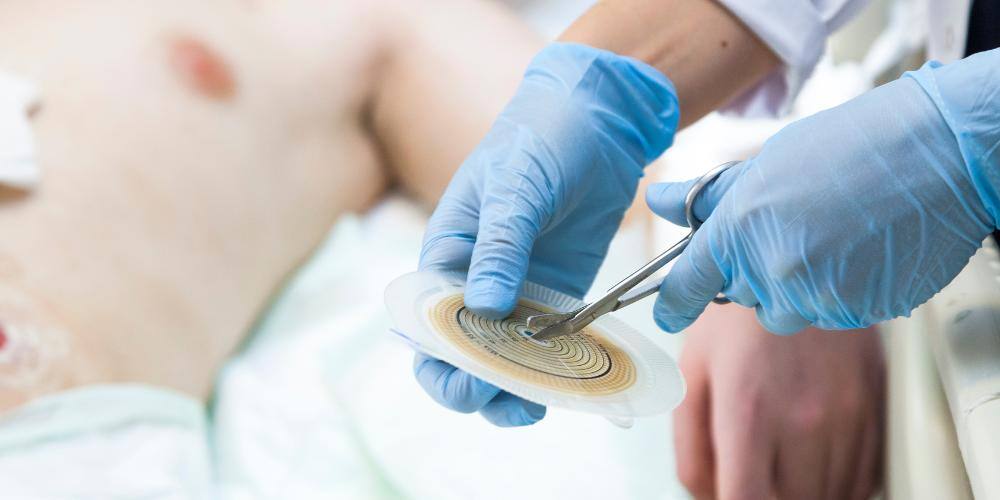 What to Expect If Surgery Is Part of Your Colorectal Cancer Treatment Plan